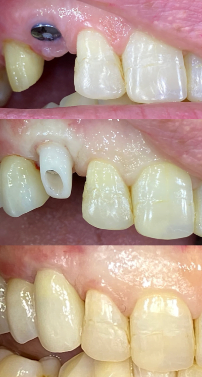 Dental Implants | Victor Harbor, Goolwa & Beyond | Call Us Today